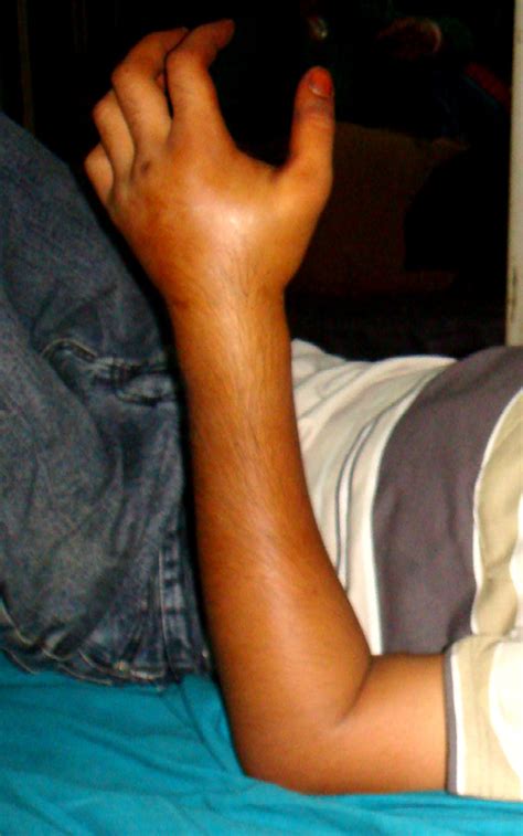 Swelling Shown Extending Up The Forearm To The Elbow Of The Left Hand Download Scientific