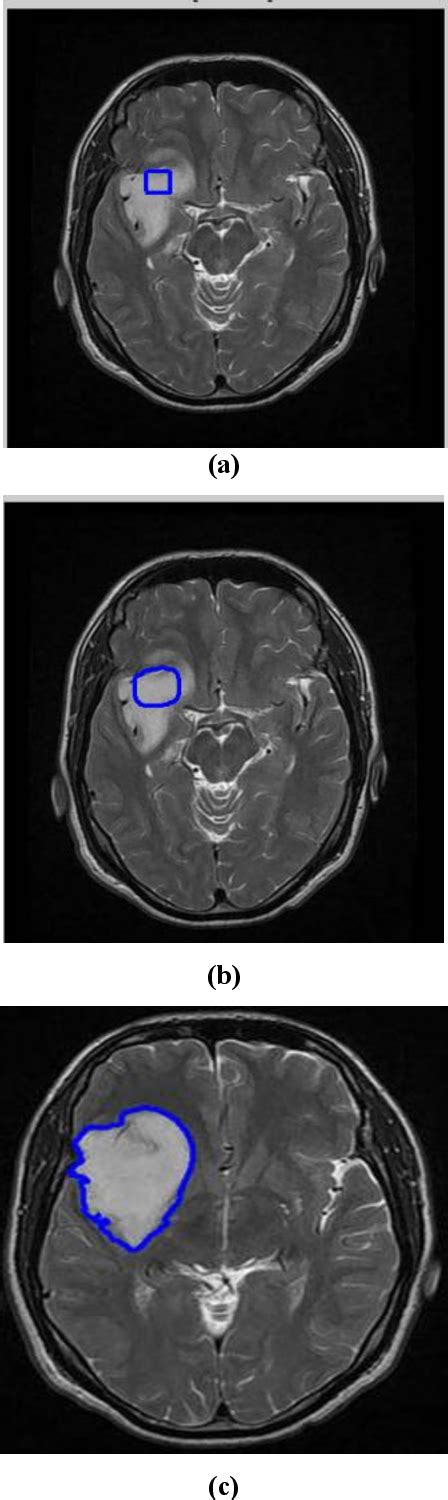 Figure 3 From A Novel Approach For Brain Tumor Segmentation Using