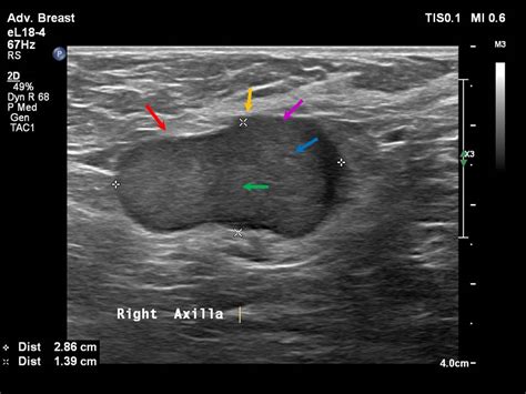 Axillary Lymphadenopathy