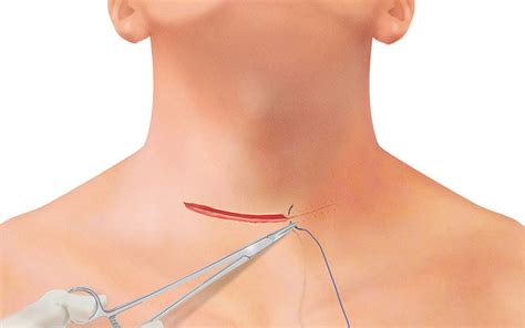 Thyroidectomy Procedure Guide Thunderbeat™ Open Fine Jaw Olympus