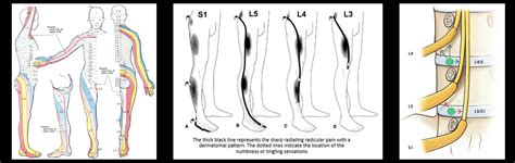 Lumbar Facet Dermatomes