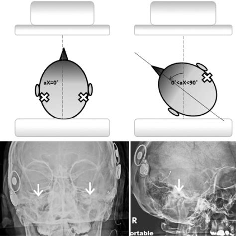 Pdf Measurement Of Cochlear Implant Electrode Position From Intraoperative Post Insertion