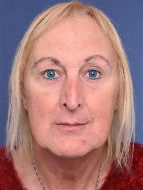 2pass Clinic Worldwide Reference In Naturally Feminizing Your Face