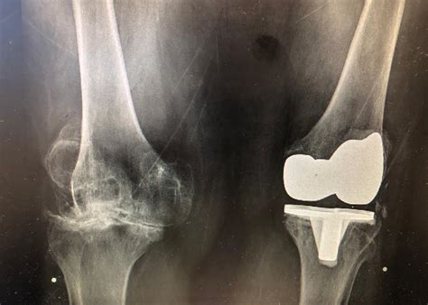 Vinod Dasa Md On Linkedin 70 Yo Patient Perfectly Happy W Left Tka Left Knee X Rays Were Just