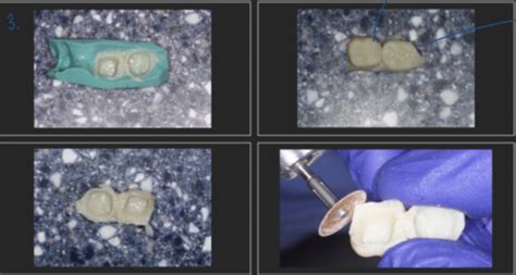 Provisional Restorations Flashcards Quizlet