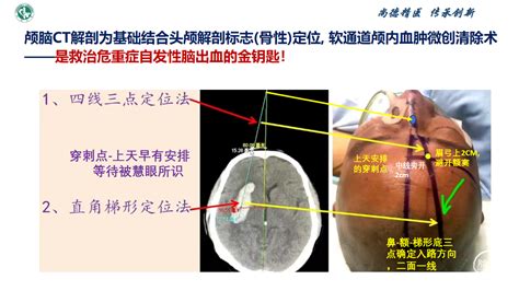 新技术脑出血微创锥颅软通道引流理念 脑医汇
