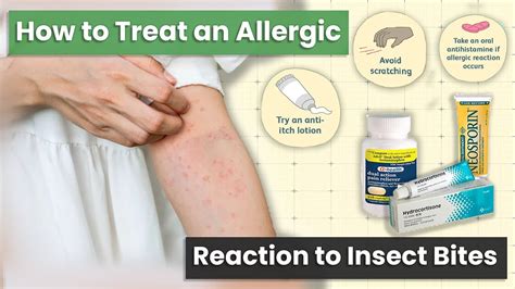 Doctors Reveal How To Treat An Allergic Reaction To Insect Bites Using