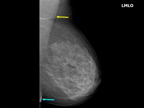 Atlas Of Breast Cancer Early Detection