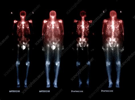 Bone Scan Of Metastatic Disease Stock Image C003 4689 Science Photo Library