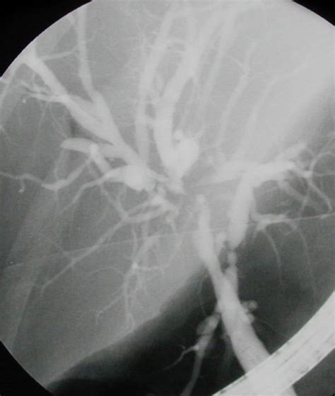 Radiology Biliary Ductal Dilation Journal Of Online Hepatology