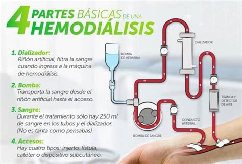 X Diálisis Hemodialisis ¿qué Es La Hemodiálisis La Hemodiálisis Es