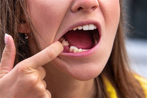 How Do Gums Heal After Tooth Extraction