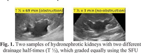 Table 1 From Pediatric Hydronephrosis Severity Assessment Using Convolutional Neural Networks