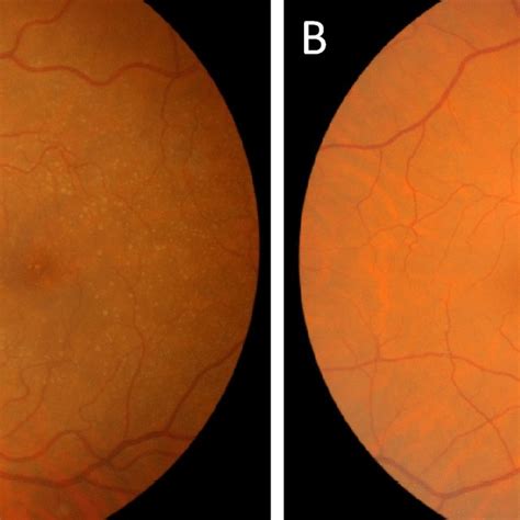 Retinal Imaging Demonstrating A Mild Microvascular Retinopathy With