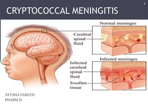 Cryptococcal Meningitis 160406120744 Pptx