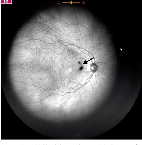 Figure 6 From Visualization And Grading Of Vitreous Floaters Using