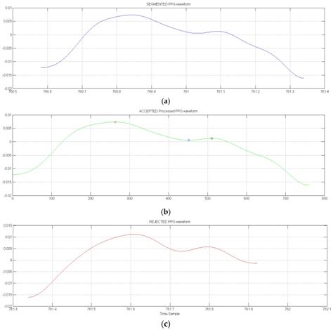 An Advanced Bio Inspired Photoplethysmography Ppg And Ecg Pattern Recognition System For
