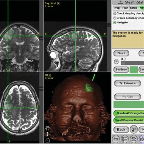 Pdf Fundamentals Of Brain Tumor Surgery In Eloquent Areas