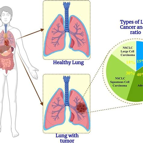 Lung Cancer Types And Ration Of Sclc And Nsclc Download Scientific Diagram