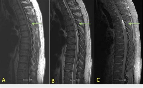 Mri Thoracic Spine Sagittal T1 A T2 B T1 Fat Suppression With Download Scientific Diagram