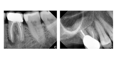 Интраорален сензор Ez Sensor Classic