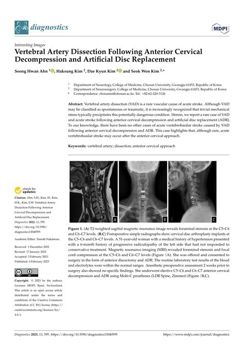Pdf Vertebral Artery Dissection Following Anterior Cervical Decompression And Artificial Disc