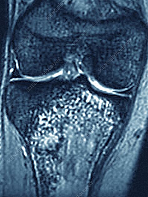 Osteosarcoma Mri Stock Image C021 3921 Science Photo Library