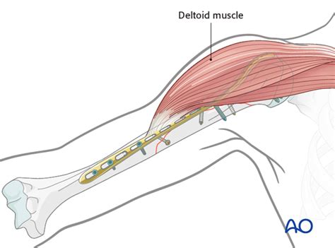 Orif Plate Fixation Proximal 1 3 For Multifragmentary Fracture Intact Segment