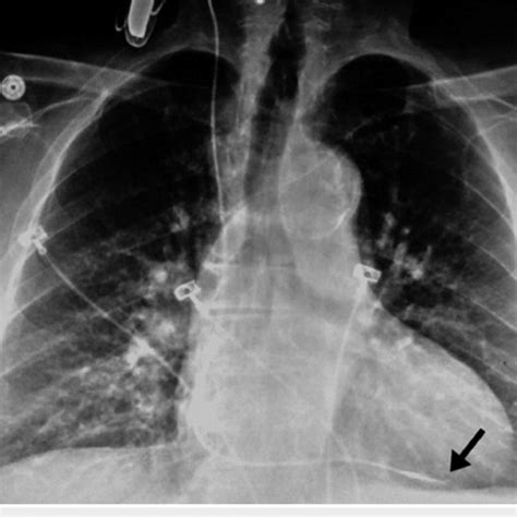 Cxr Confirming The Placement Of The Transvenous Pacemaker Tip In The