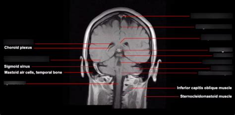Frontal Plane Mri