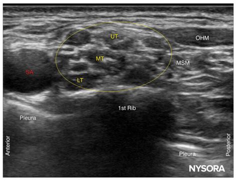 Tips For A Supraclavicular Brachial Plexus Block Nysora