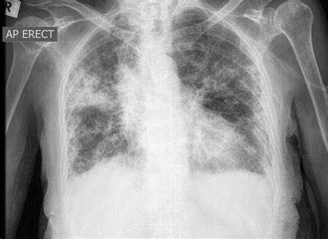 Pulmonary Consolidation Chest X Ray Medschool