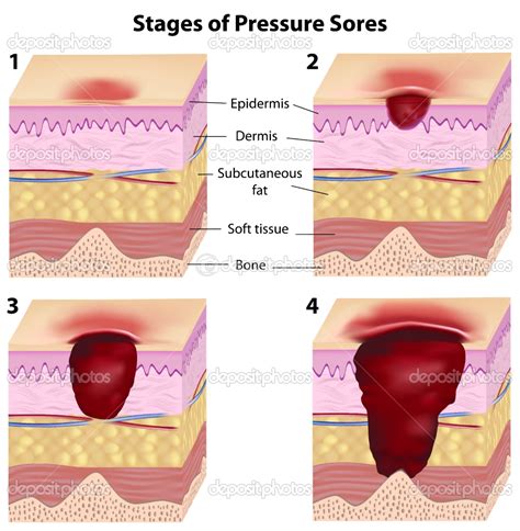 Nursing Care In The Elderly Patient Care Of Aging Skin And Mucous