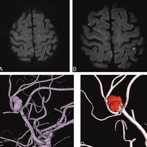 A 75 Year Old Woman With A 10 81 Mm Basilar Tip Aneurysm Underwent