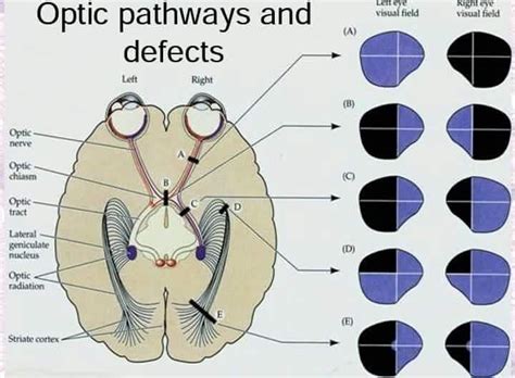 Inferior Temporal Visual Field Defect