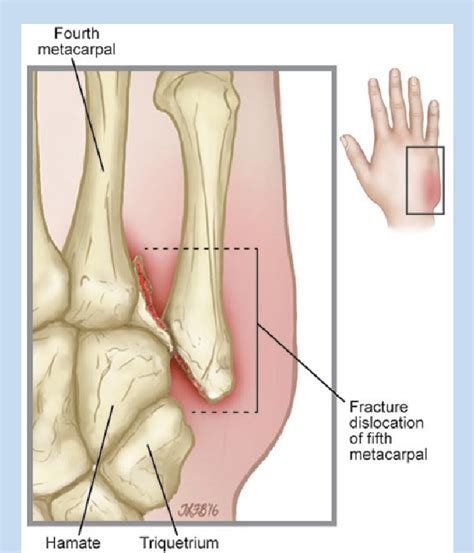 Small Finger Carpometacarpal Cmc Fracture Dislocation Anatomy There