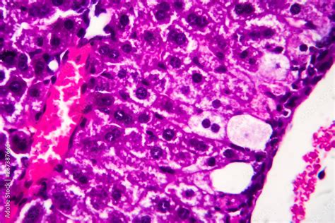 Histopathology Of Acute Hepatitis Light Micrograph Photo Under Microscope High Magnification