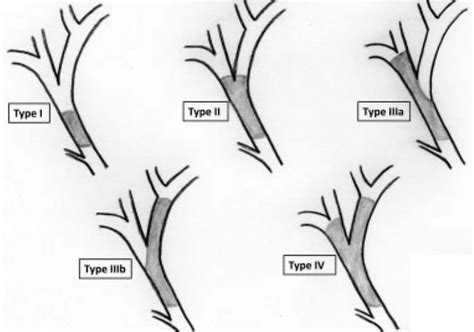 Klatskin Tumor Hilum근처 간문부 담관암 의 Bismuth 분류와 수술적 치료