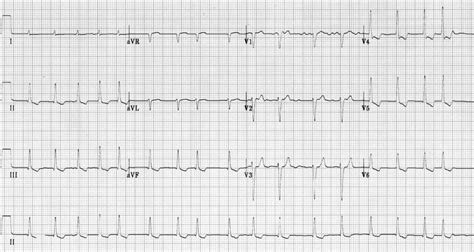 Digoxin Effect • Litfl • Ecg Library Toxicology