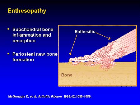 Advancing The Art And Science Of Treating Ra And Spondyloarthropathies