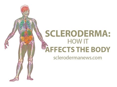Understanding The Different Symptoms Of Scleroderma