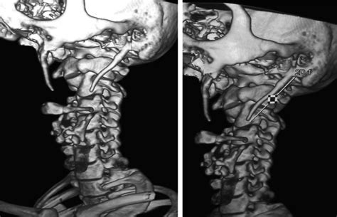 Stylalgia And Styloidectomy A Review Pmc