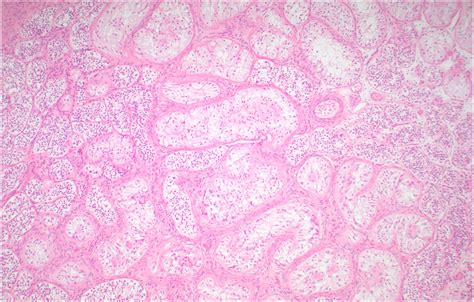 Observer Variation In The Diagnosis Of Testicular Sex Cord Stromal