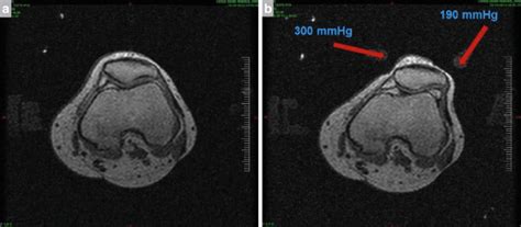 7 Dynamic Mri Evaluation Check Patellofemoral Joint At Rest A