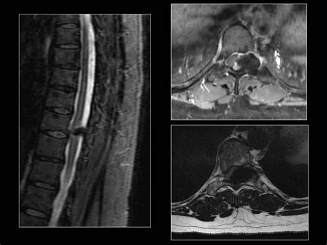 Facet Joint Hypertrophy Mri At Marcus Hanger Blog