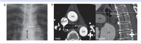 Figure 1 From Use Of Vertebral Body Units To Locate The Cavoatrial