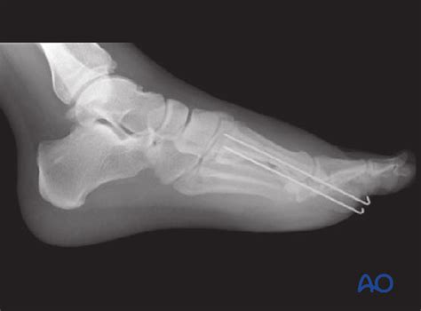 First Metatarsal Fracture