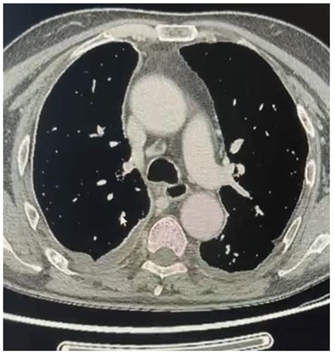 The Role Of Hyperthermic Intrathoracic Chemotherapy Hithoc In Thoracic Tumors