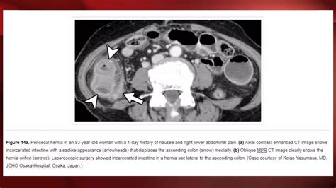 Ct Of Internal Hernia Pptx