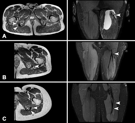 Pulled Hamstring Mri